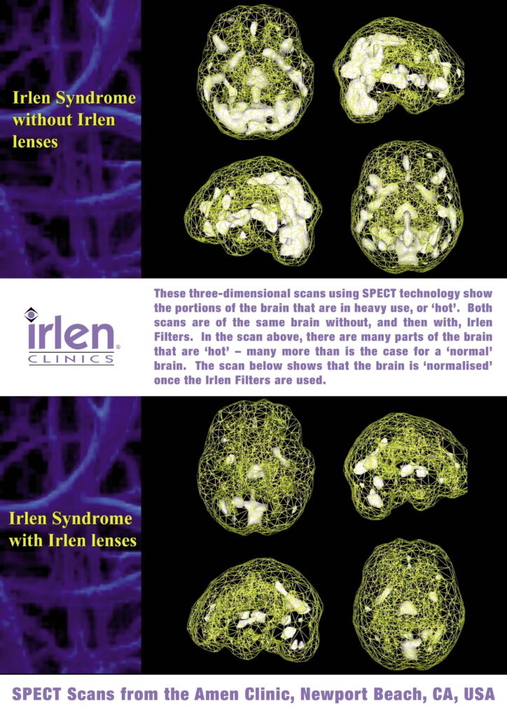 Irlen Syndrome – Irlen NZ